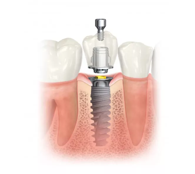 Dantų implantavimas – Klevu Alejos Odontologijos Klinika